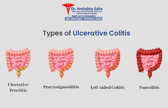 Ulcerative Colitis: The Complete Guide